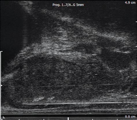 The Role Of Transperineal Template Biopsies In The Diagnosis Of Prostate Cancer Urology News