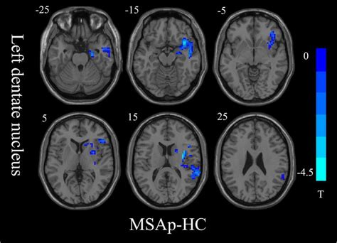 Statistical Parametric Map Showing The Significant Differences In The Download Scientific