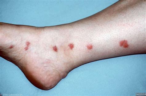 Opmars Van Persisterende Insectenbeten Huidarts Com