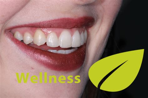 Invisalign Composite Bonding And Veneers Oneill Dental Care