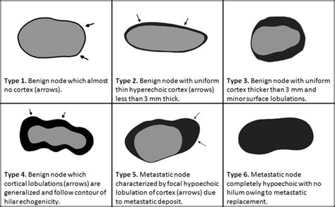 Lymphadenopathy Vs Benign Reactive Vs Malignant Lymph Nodes