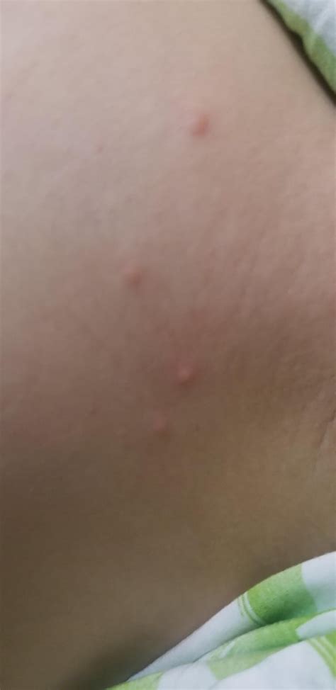 Bug Bite Identification Hue R Vietnam