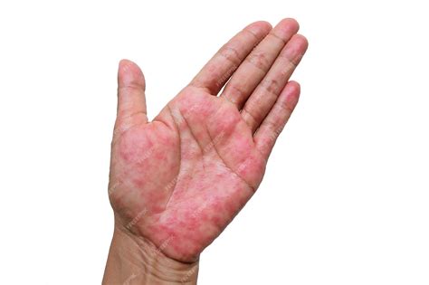 Premium Photo Atopic Dermatitis Ad Also Known As Atopic Eczema Is A Type Of Inflammation Of
