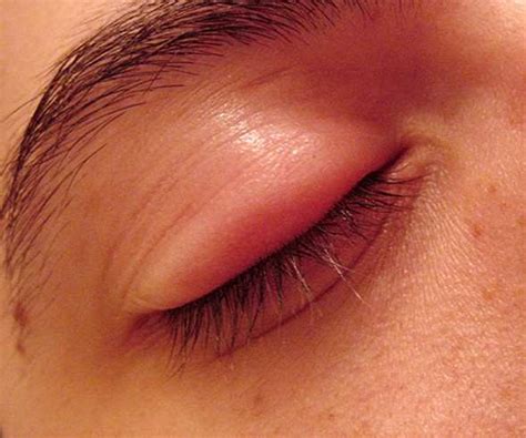Swollen Eyelid Symptoms Treatment Pictures Causes Hubpages