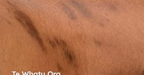 Acquired Dermal Macular Hyperpigmentation Image