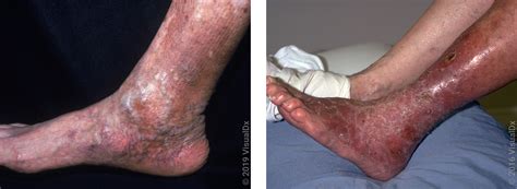 Stasis Dermatitis Pictures Causes And Treatment Goodrx