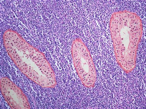 Testicular Cancer Light Micrograph Stock Image C021 1137 Science Photo Library