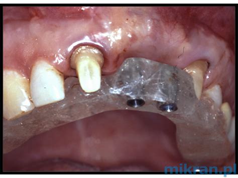 Primo Splint Kit Universal Light Cured Molding Material Promotion