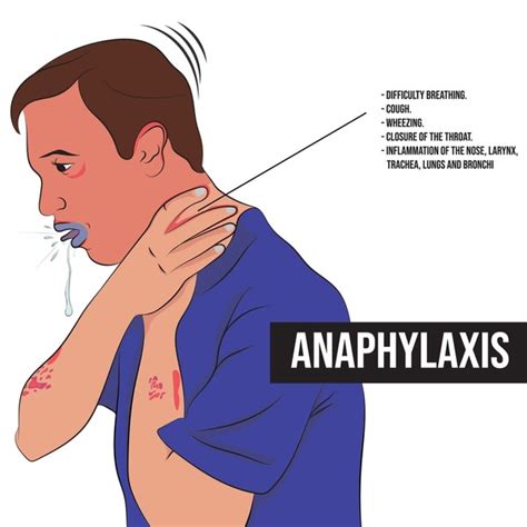 Anaphylaxis Causes Symptoms Diagnosis Treatment 46 Off