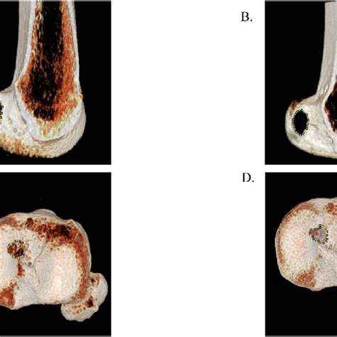 Measurement Method Of Maximal Cross Section Areas In Bone Tunnel By 3 D Download Scientific