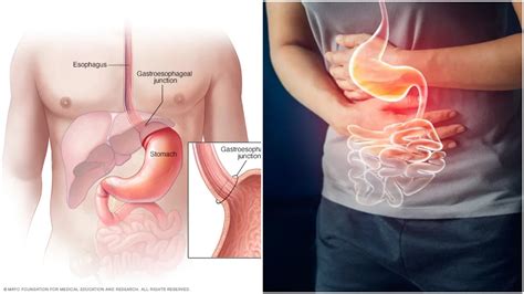 Early Signs And Symptoms Of Stomach Cancer In Kannada ನಿಮ್ಮಲ್ಲಿ ಈ 4