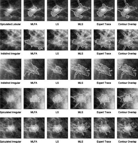 Segmentation Results From Left To Right They Are The Original Roi Download Scientific