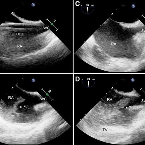A Bicaval View And C Modified Bicaval View Without Contrast B Download Scientific Diagram
