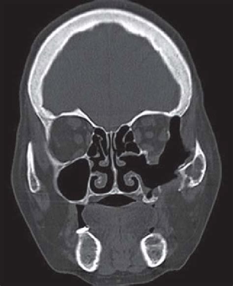 Postoperative Ct Scan Bone Window Showing Clearance Of The Affected Download Scientific