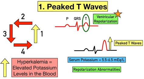 Hyperkalemia Ekg