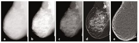 Breast Imaging Physics In Mammography Part II