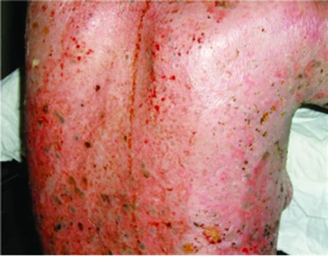 Trichloroethylene Induced Hypersensitivity Dermatitis Was Associated