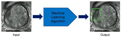 Prostate Lesion Detection Using Machine Learning Methods The Computer