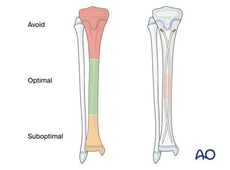 Elastic Nailing For Simple Transverse Tibial Fracture
