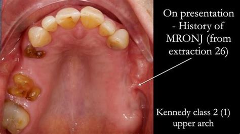 Finlays Newsletter 60 Sylvias Upper Kennedy Class 2 Mod 1 Metal Based Upper Rpd Finlay