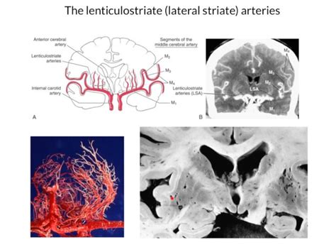 Lenticulostriate Arteries Stroke