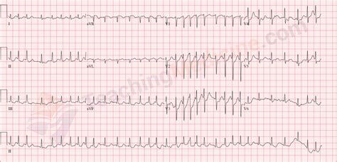 Teaching Medicine Tutorial Rhythm Diagnostic Criteria