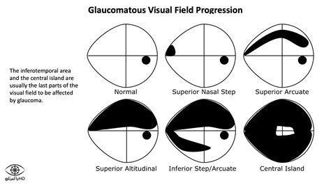 Glaucoma Visual Field
