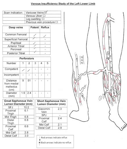 Venous Reflux Treatment Singapore Dr Darryl Lim