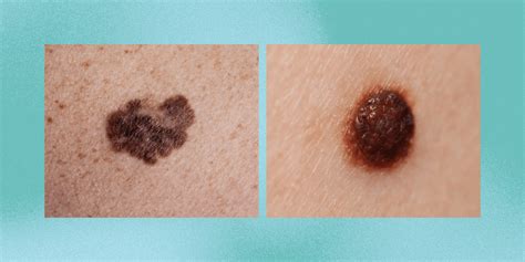 How To Tell If Your Suspicious Mole Might Be Skin Cancer