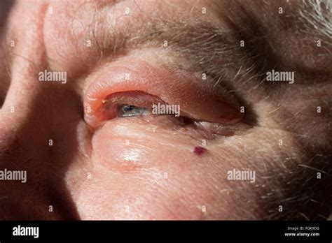 Squamous Blepharitis