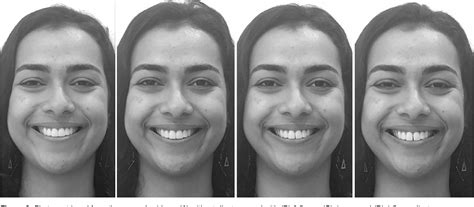Figure 2 From Does The Presence Of Maxillary Midline Diastema Influence