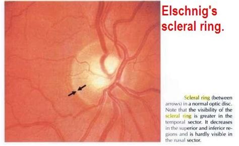 Medicine Decoded Eponyms About Elschnig In Ophthalmology
