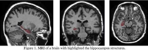 Figure 1 From Hippocampus Segmentation Via Active Contour Model Semantic Scholar