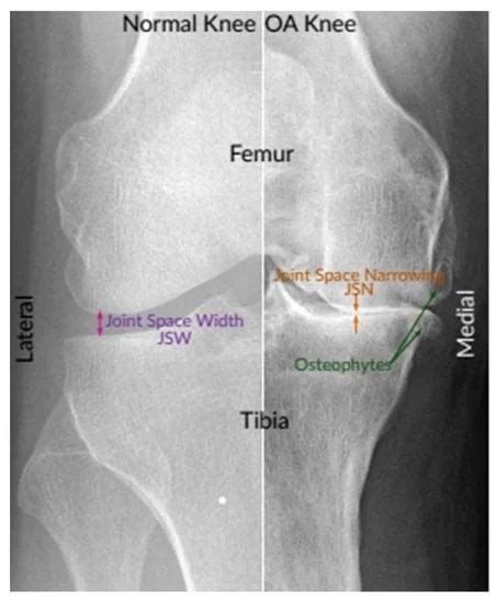 Knee Osteoarthritis Diagnosis A Deep Learning Approach With Mixture Of Experts R Programming