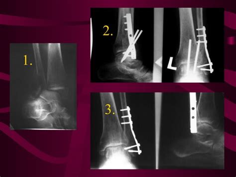 Ankle Fracture And Temporal Talocrural Fixation Power Point Ppt