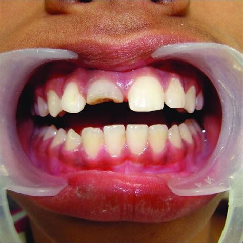 Ellis And Daveys Class Iv Fracture Of Maxillary Right Central Incisor