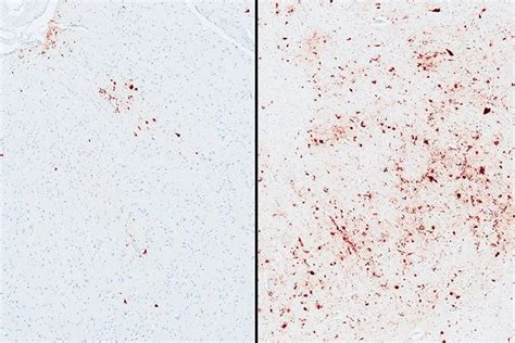 Gene Variation May Explain Most Severe Cte Futurity