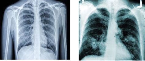 Lung Cancer Detection Using Deep Learning Based Convolutional Neural Networks Semantic Scholar