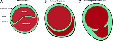 Computed Tomography Angiography For Aortic Diseases Radiologic Clinics