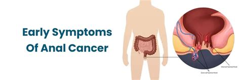 Early Symptoms Of Anal Cancer In Vizag Recognize And Act Fast