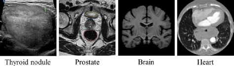 Figure 1 From Ultrasound Image Segmentation Of Thyroid Nodule Via