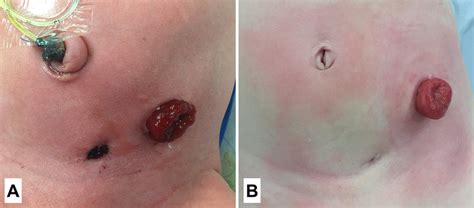 Divided Colostomy After Surgery A And At 2 Months After Surgery B