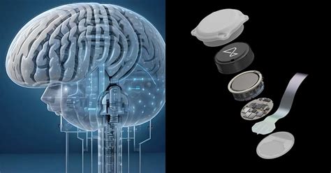 인류역사상 최초 인간의 뇌에 컴퓨터 칩 심었다 위키트리