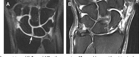 Figure 12 From Magnetic Resonance Arthrography Of The Wrist And Elbow Semantic Scholar