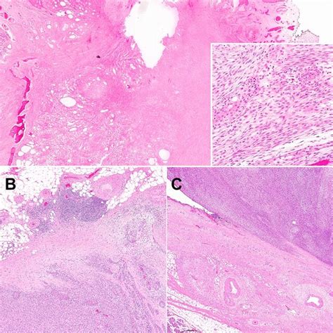 Case 1 Resection And Recurrencesmetastases A Resection Showing