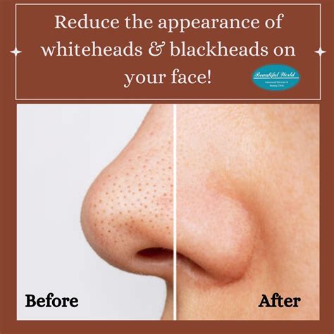 Laser Acne Treatment Artofit