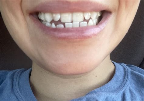 Almost There Tray 18 20 R Invisalign