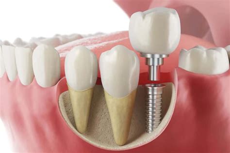 Is There A Non Metal Tooth Implant
