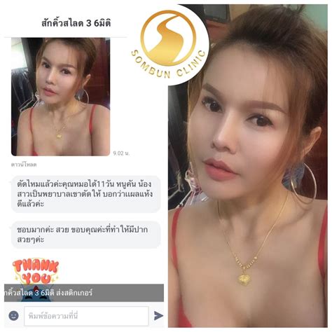 💋รีวิวปากกระจับโปรโมชั่ Sb Clinic สมบูรณ์การแพทย์ ขอนแก่น