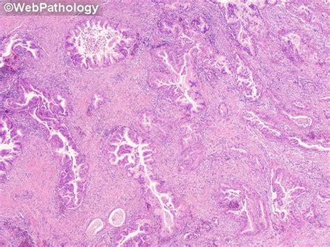 Gallbladder Carcinoma Microscopic Features